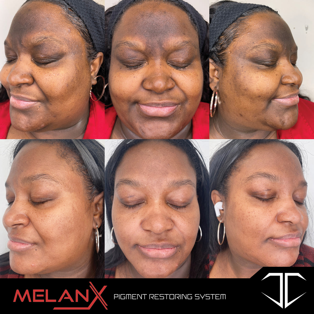 MelanX Chemical Peel | Treat Hyperpigmentation & Dark Spots at Home ...